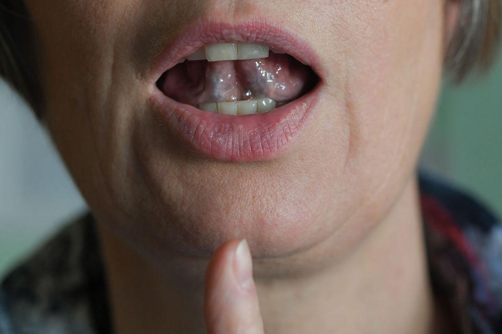 people with stuttering problems