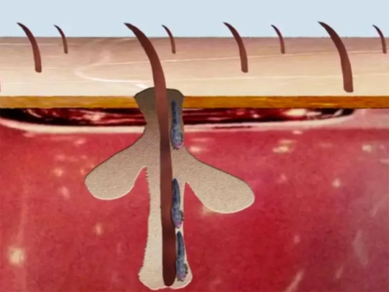 Meet the Mites That Live on Your Face | Smithsonian