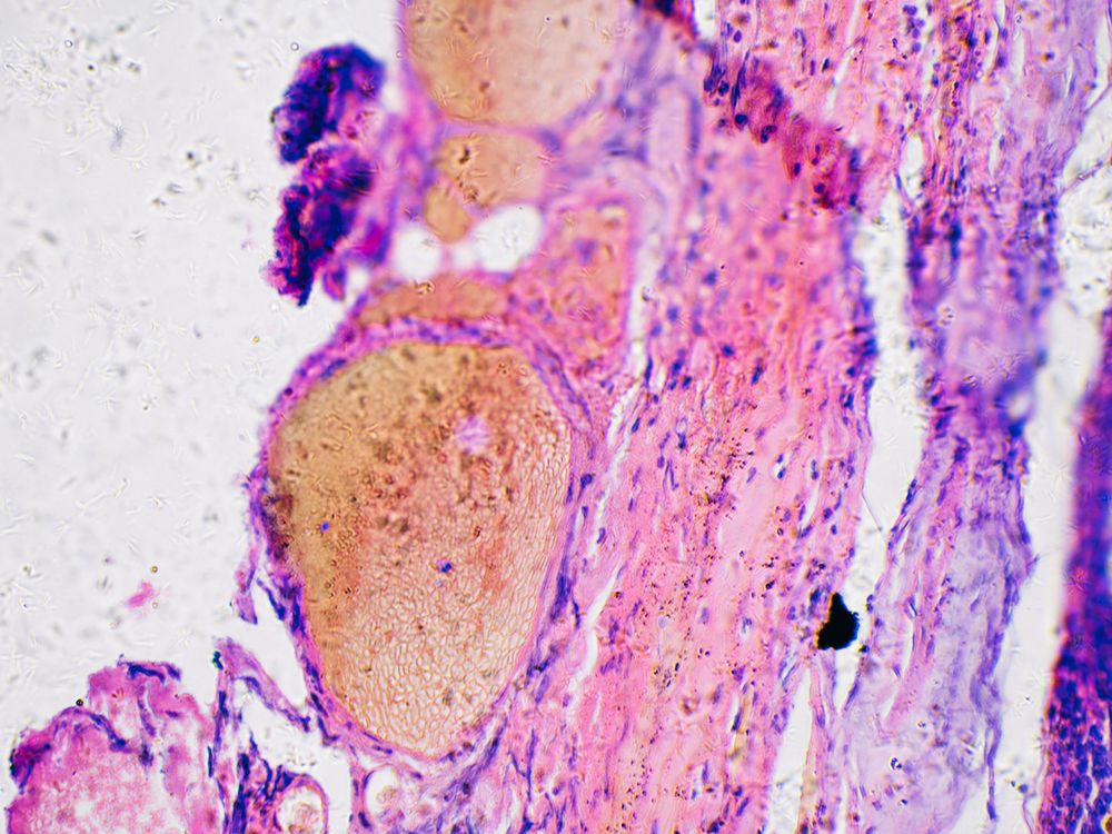 New mRNA Vaccine Shows Promise Against Skin Cancer