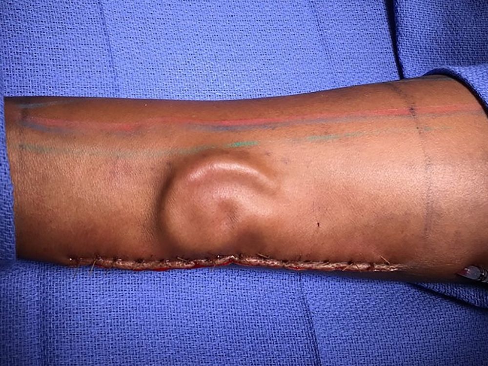 Doctors 'Grow' Ear for Transplant in Patient's Forearm