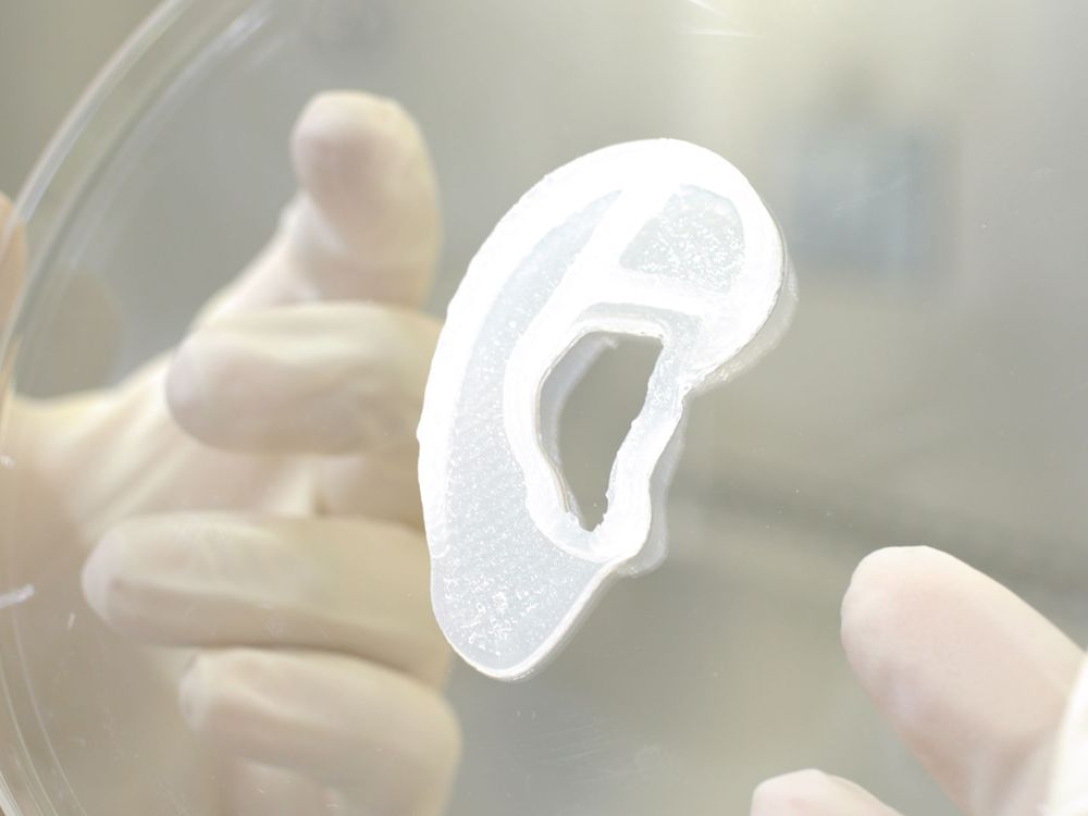Surgeons Transplant 3-D-Printed Ear Made From Patient’s Own Cells