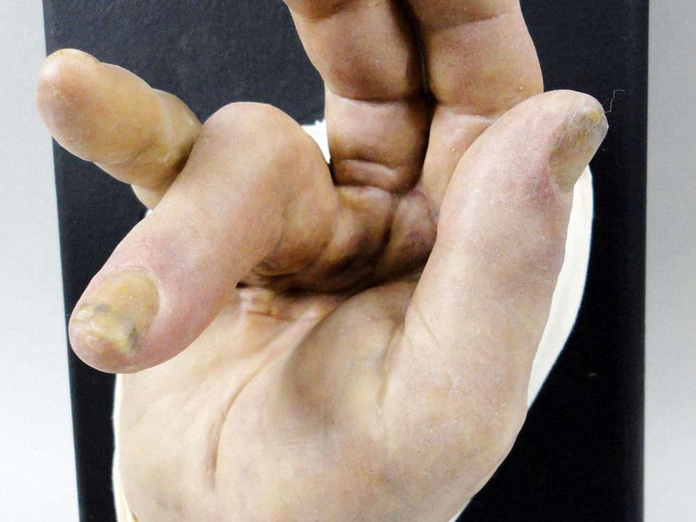 See Over 2,000 Wax Models of Skin Diseases at This Swiss Medical ...