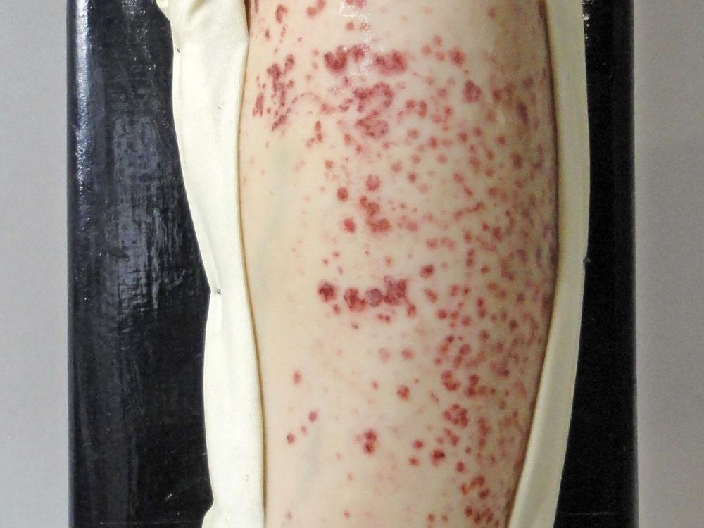 See Over 2,000 Wax Models of Skin Diseases at This Swiss Medical ...