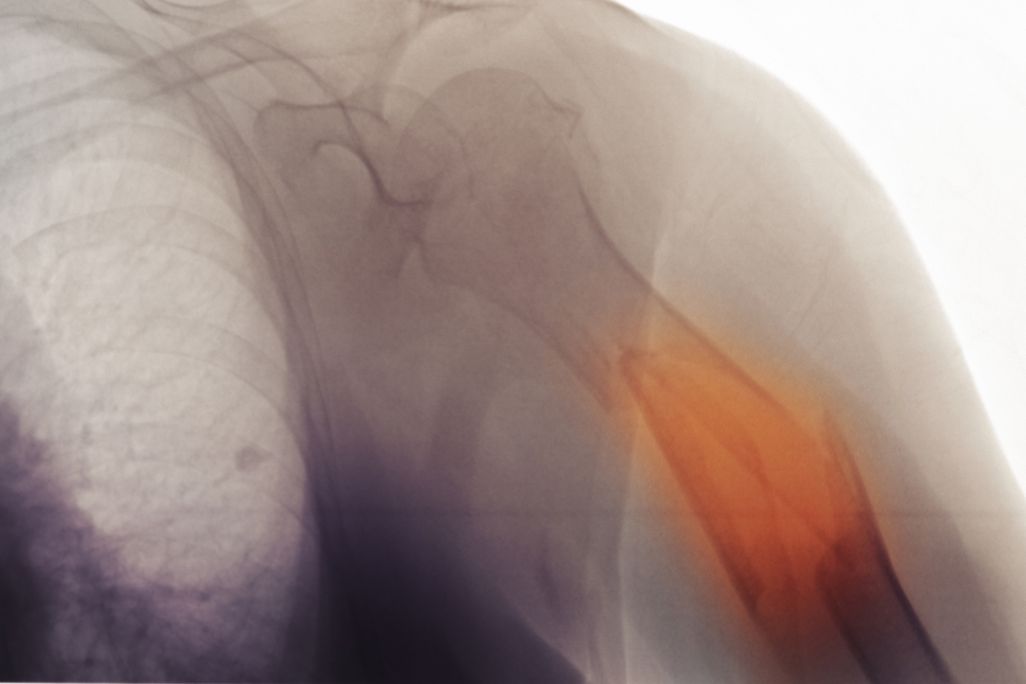 Vampire Healing: Young Blood Can Mend Old Broken Bones