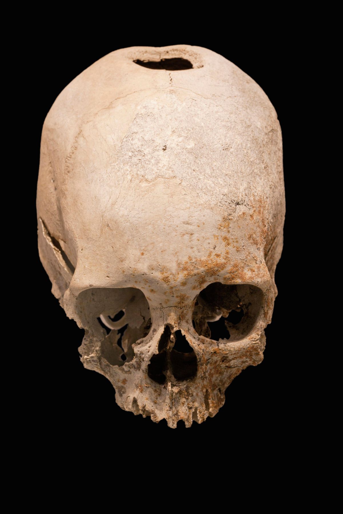 trepanation skull