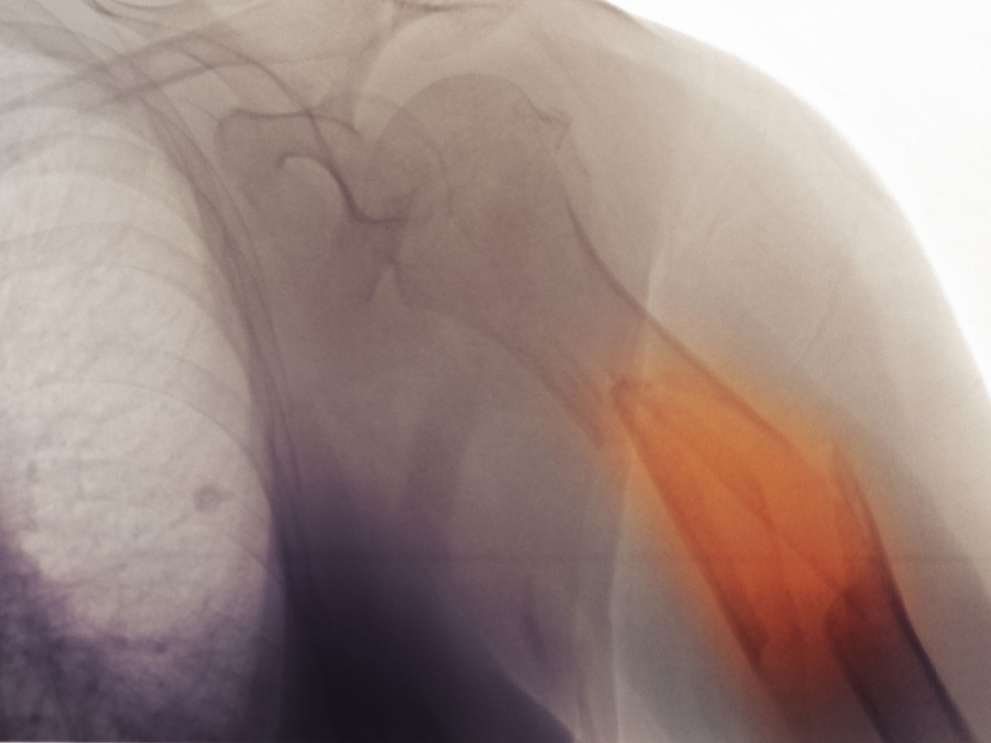 Vampire Healing: Young Blood Can Mend Old Broken Bones