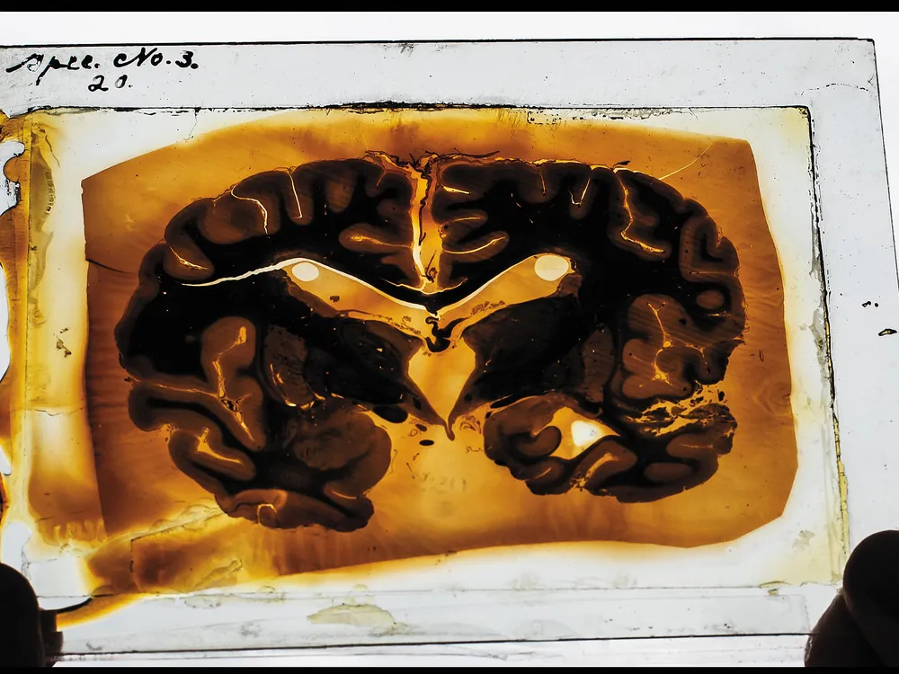 Did Civil War Soldiers Have PTSD?