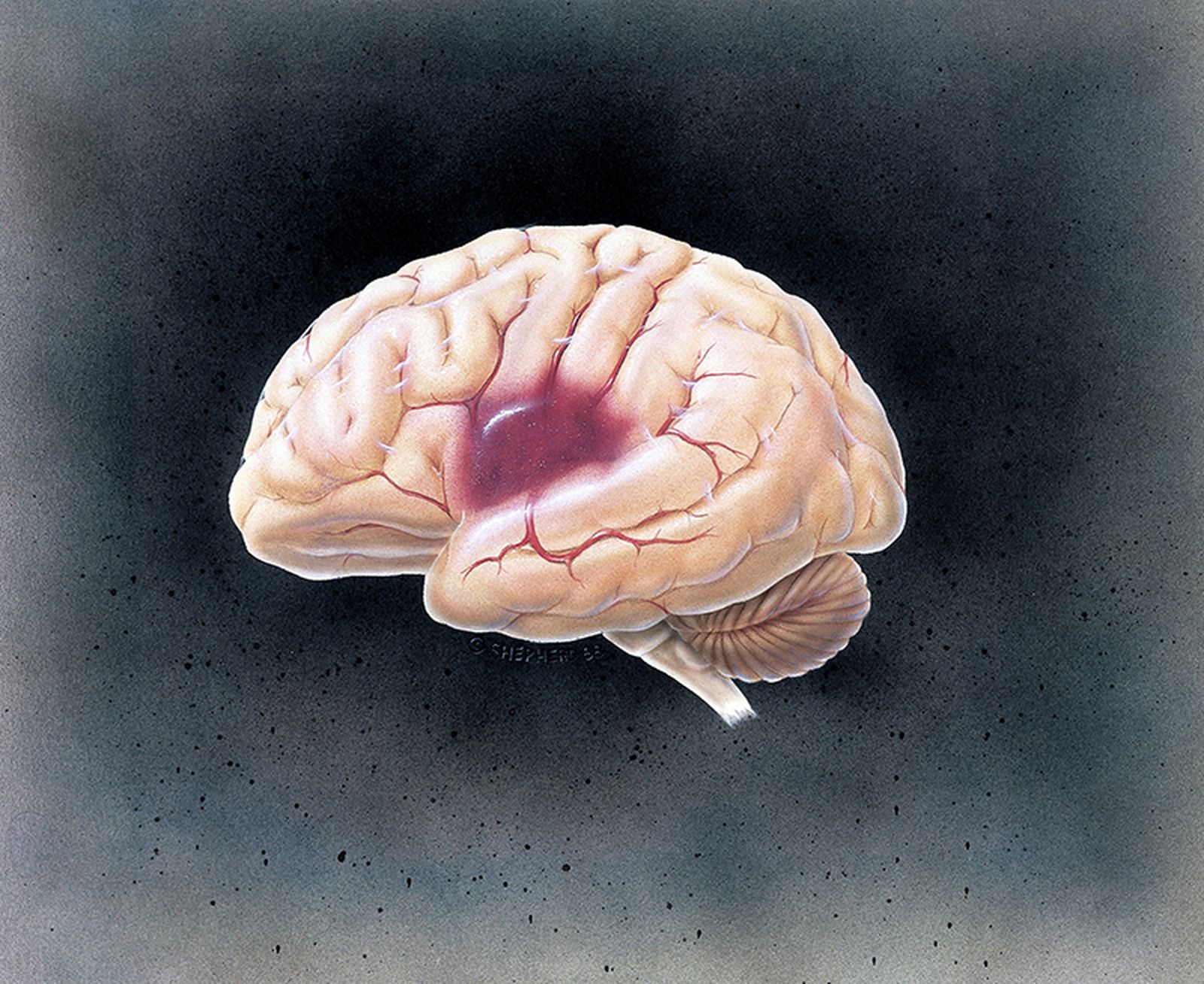 A Microwave Helmet May Help Diagnose Traumatic Brain Injury