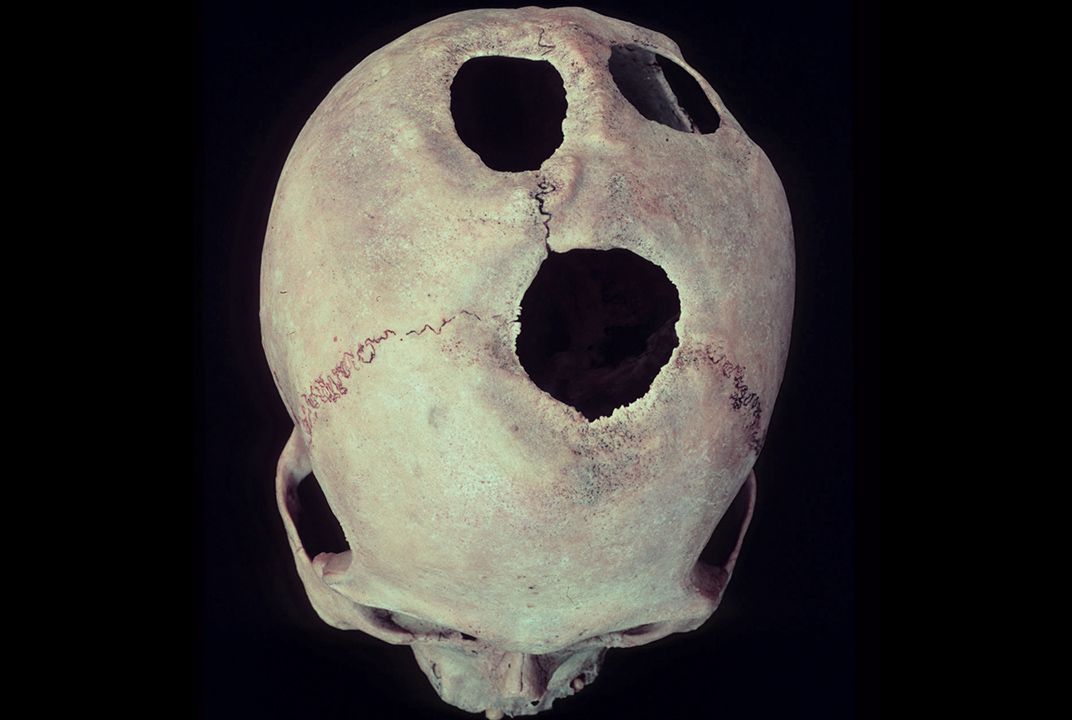 inca trepanation