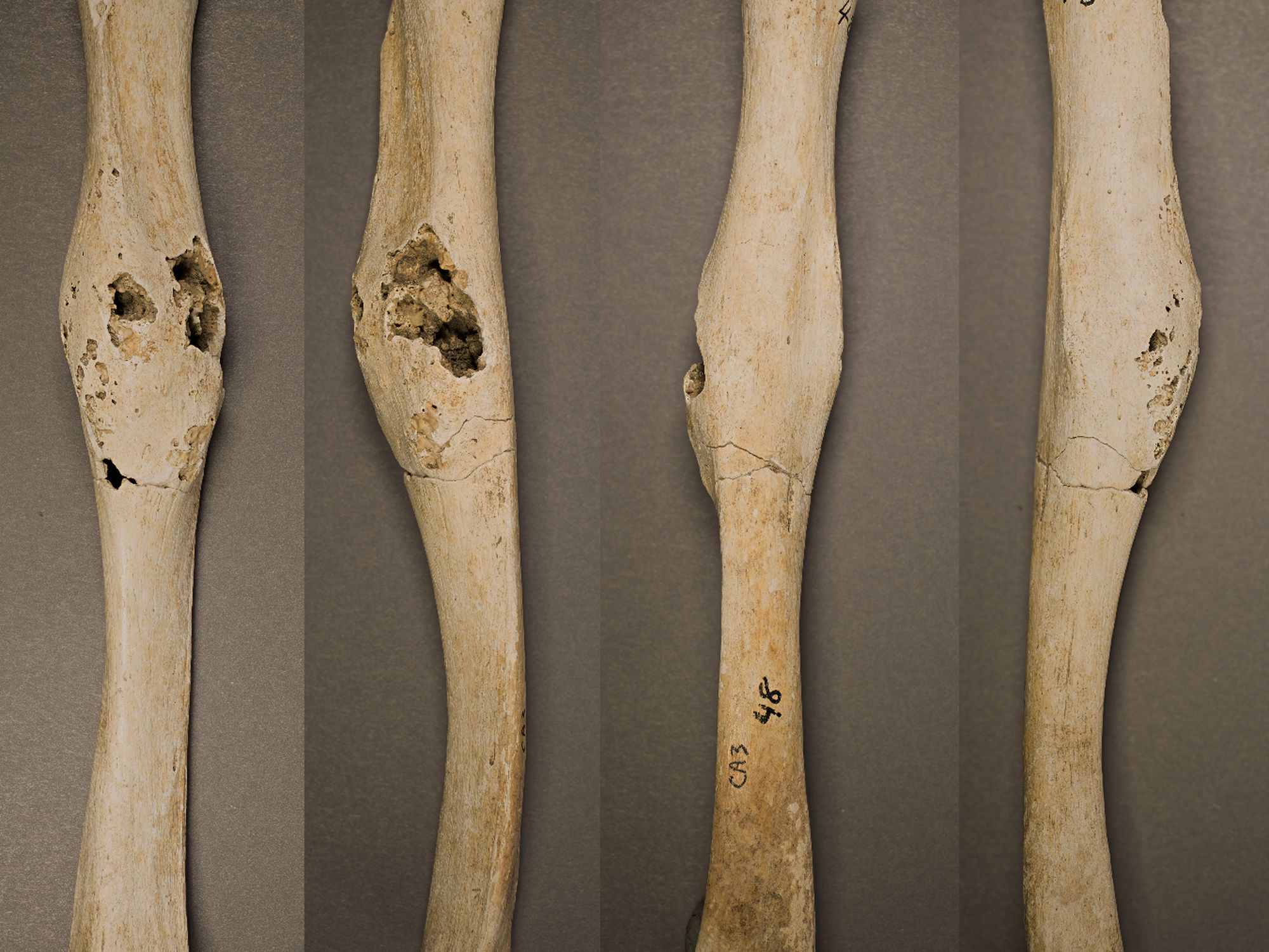 Oldest Cancer Case in Central America Discovered