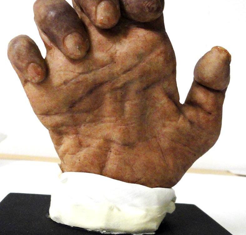 See Over 2,000 Wax Models of Skin Diseases at This Swiss Medical ...