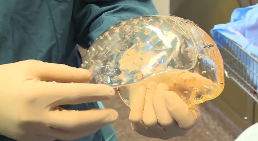 You Can Watch the First Ever Operation to Transplant a 3D-Printed Skull ...